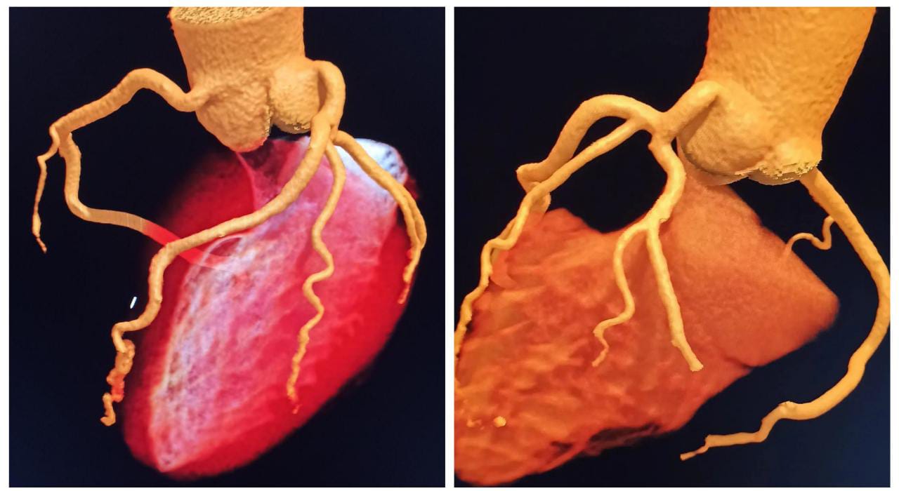 Curso de Angio Tomografia Coronariana - CCR